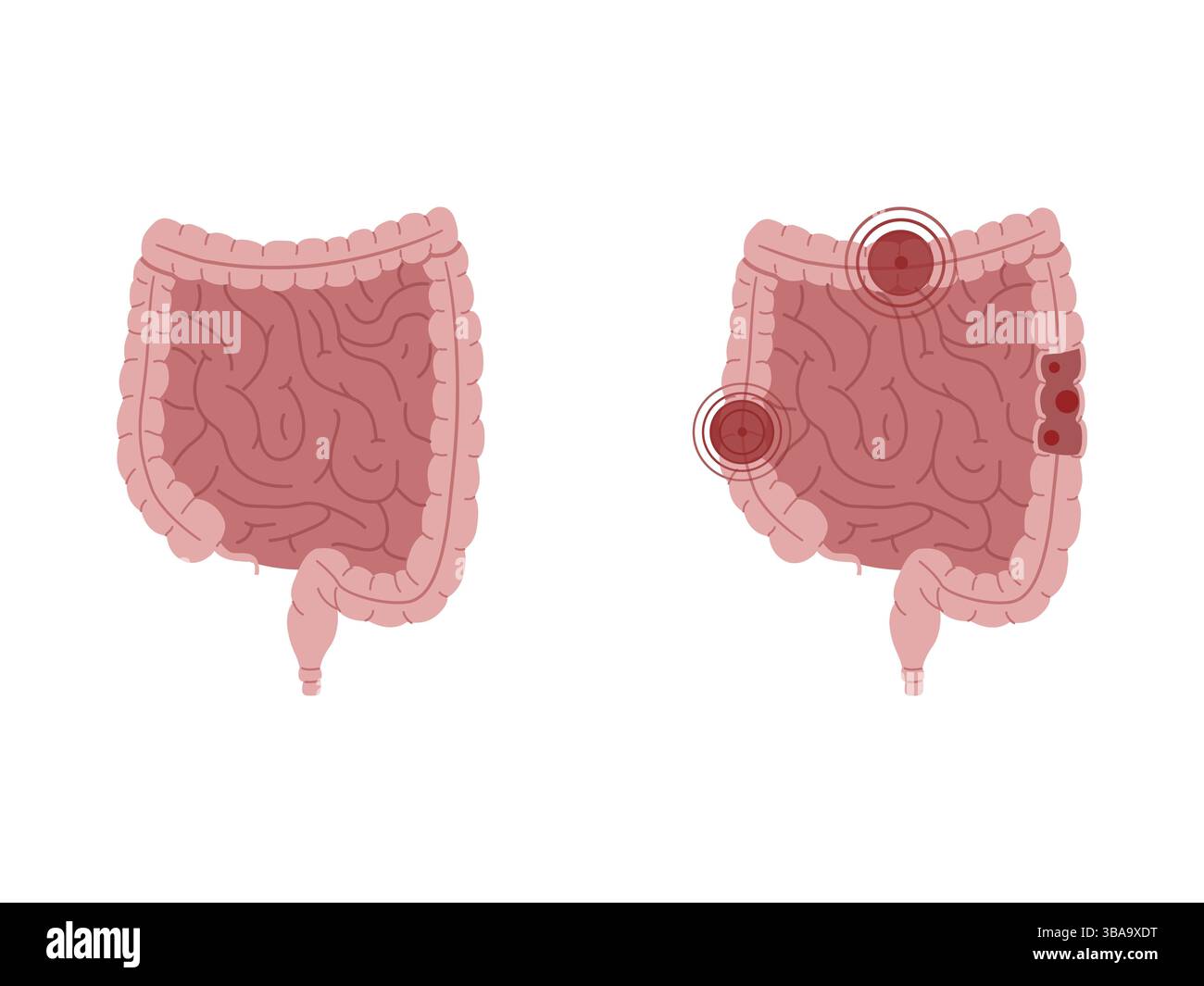 Flat vector illustration of healthy intestines and intestines with ...