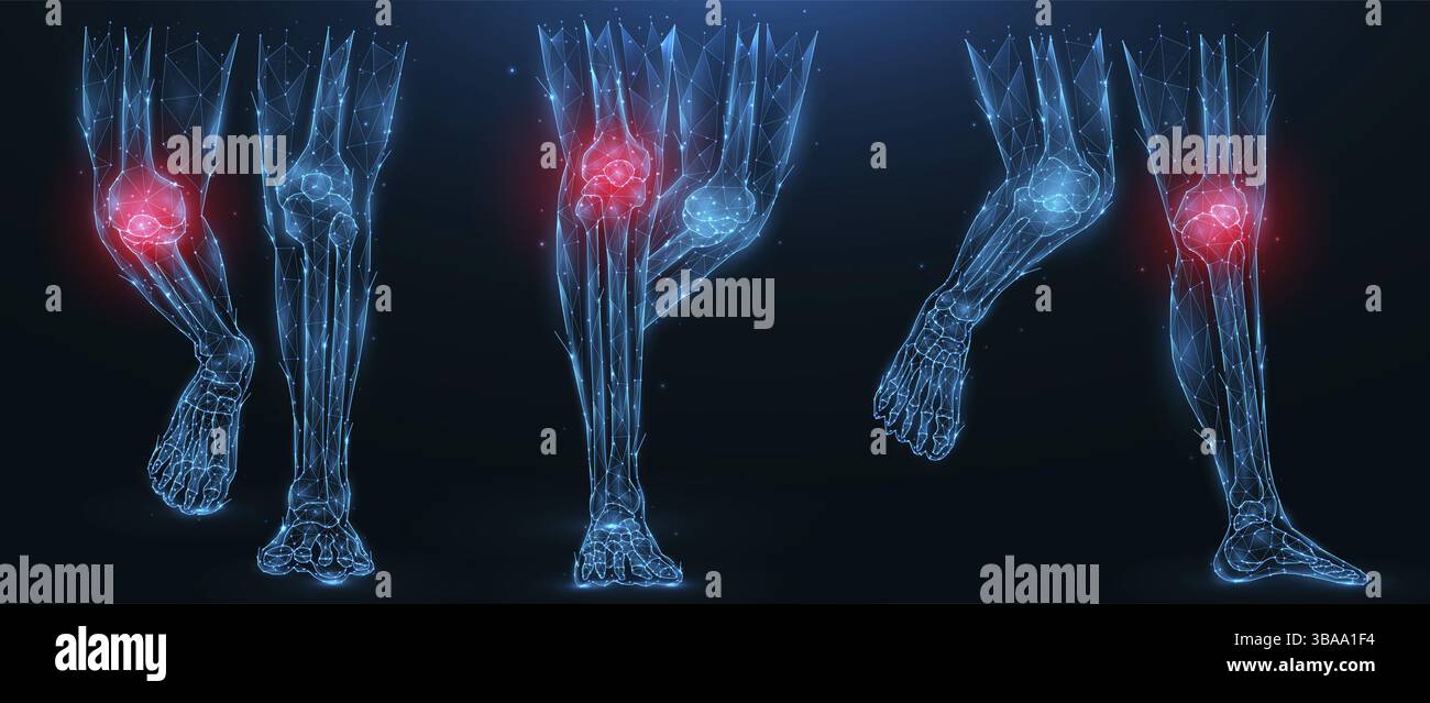 Polygonal vector illustration of human legs, inflammatory disease of ...