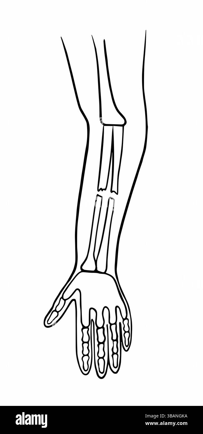 Vector isolated illustration of a closed forearm fracture. Outline ...
