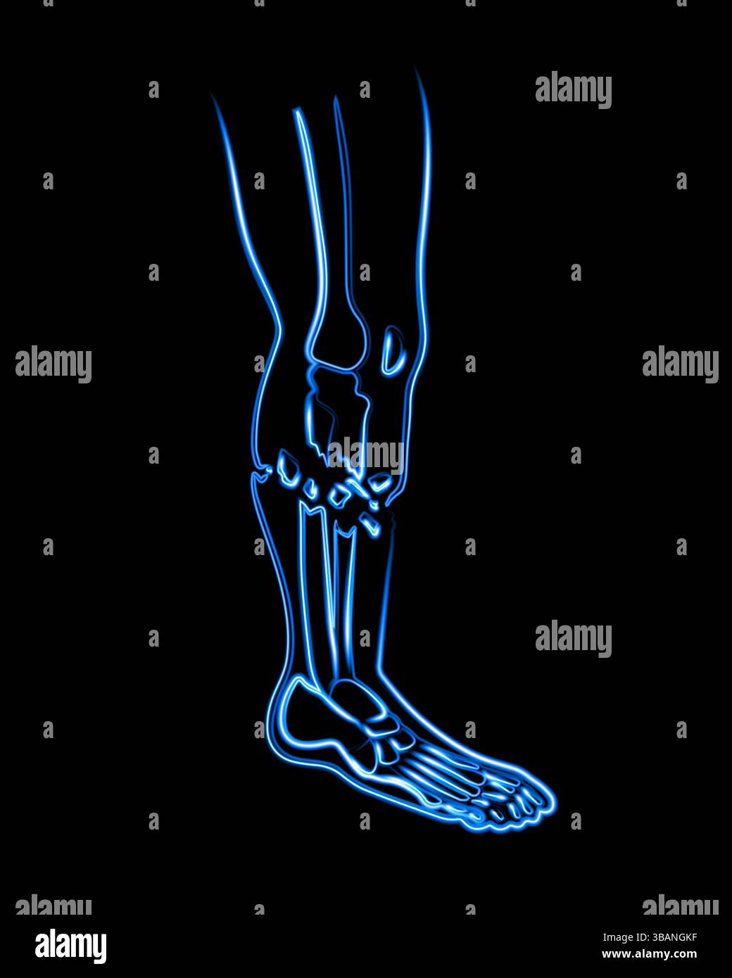 Vector isolated illustration of an open fracture of the tibia with neon ...