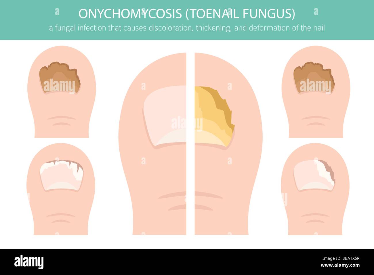 Medical vector illustration of onychomycosis – a common fungal toenail ...