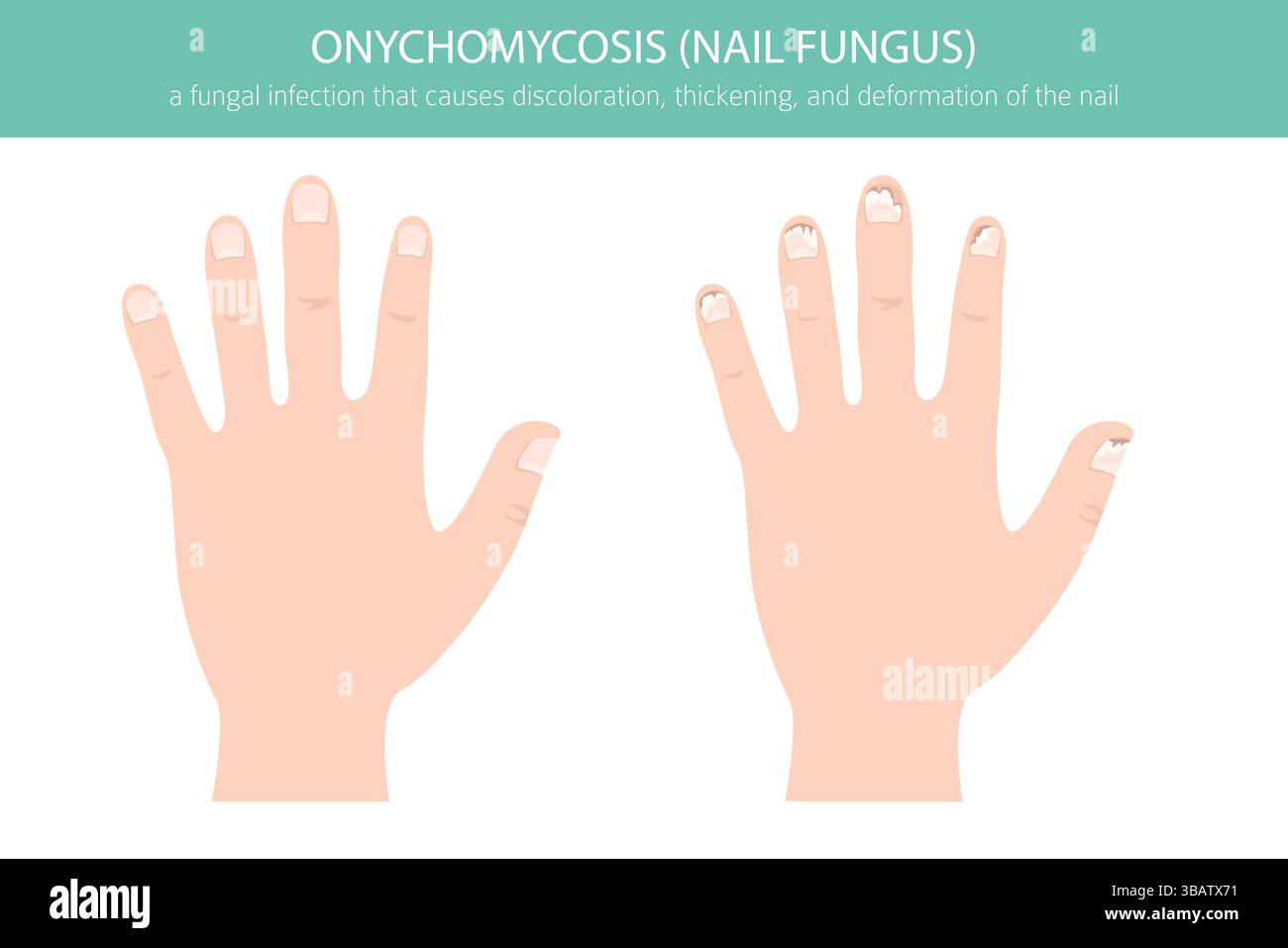 Medical vector illustration of onychomycosis – a common fungal toenail ...