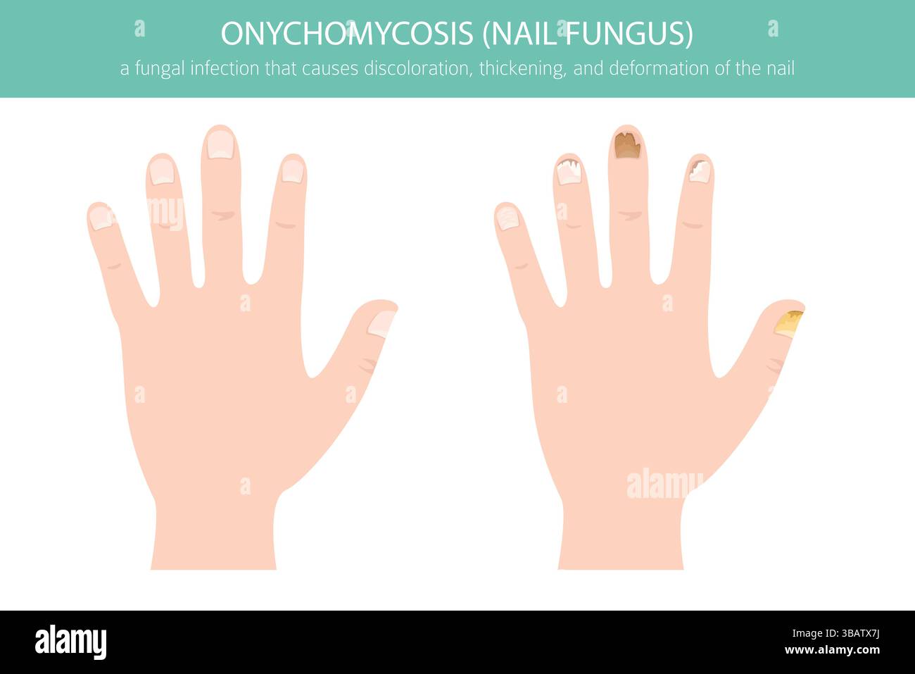 Medical vector illustration of onychomycosis – a common fungal toenail ...