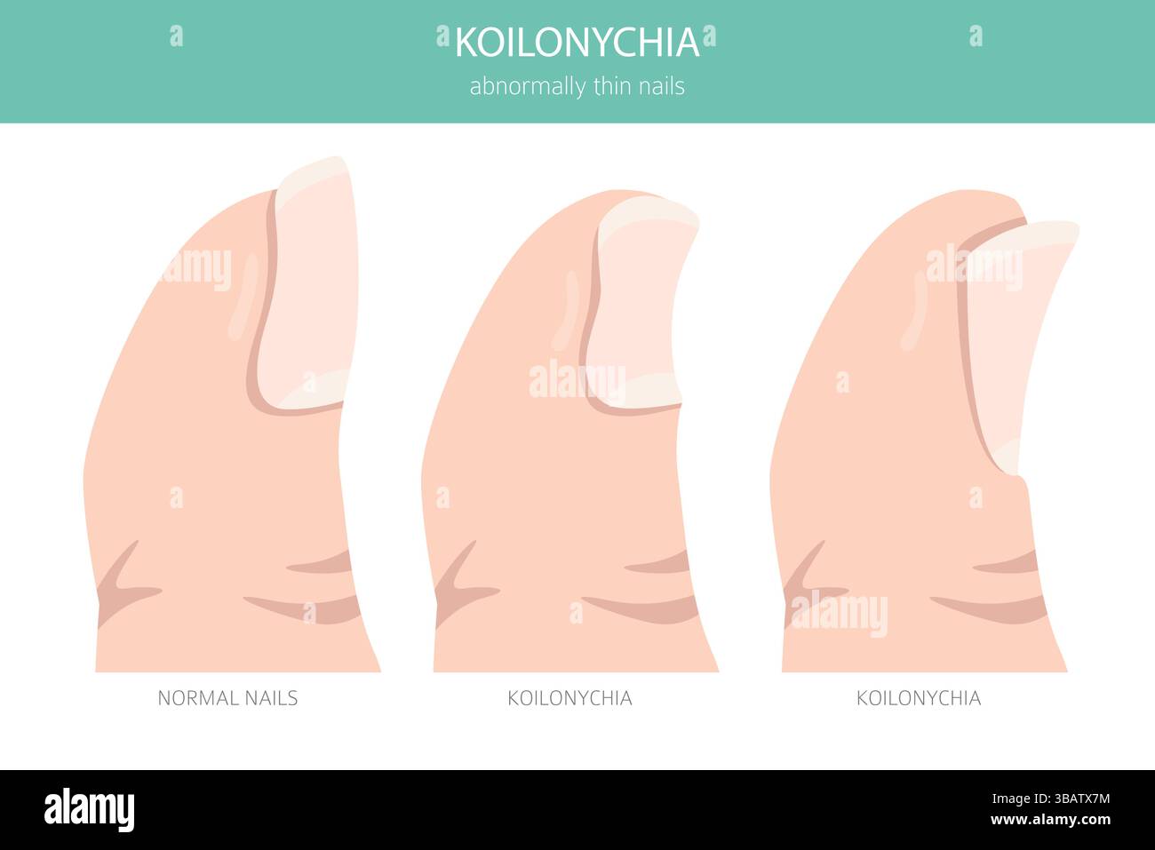 Koilonychia, or spoon nails, is a nail condition where nails become ...