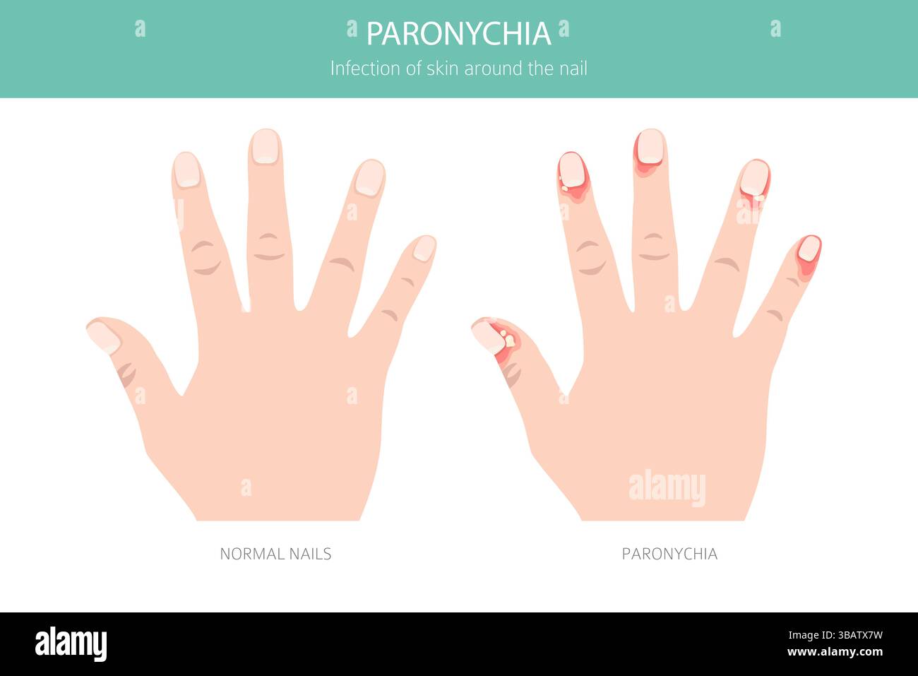 Paronychia is an infection of the nail fold causing redness, swelling ...