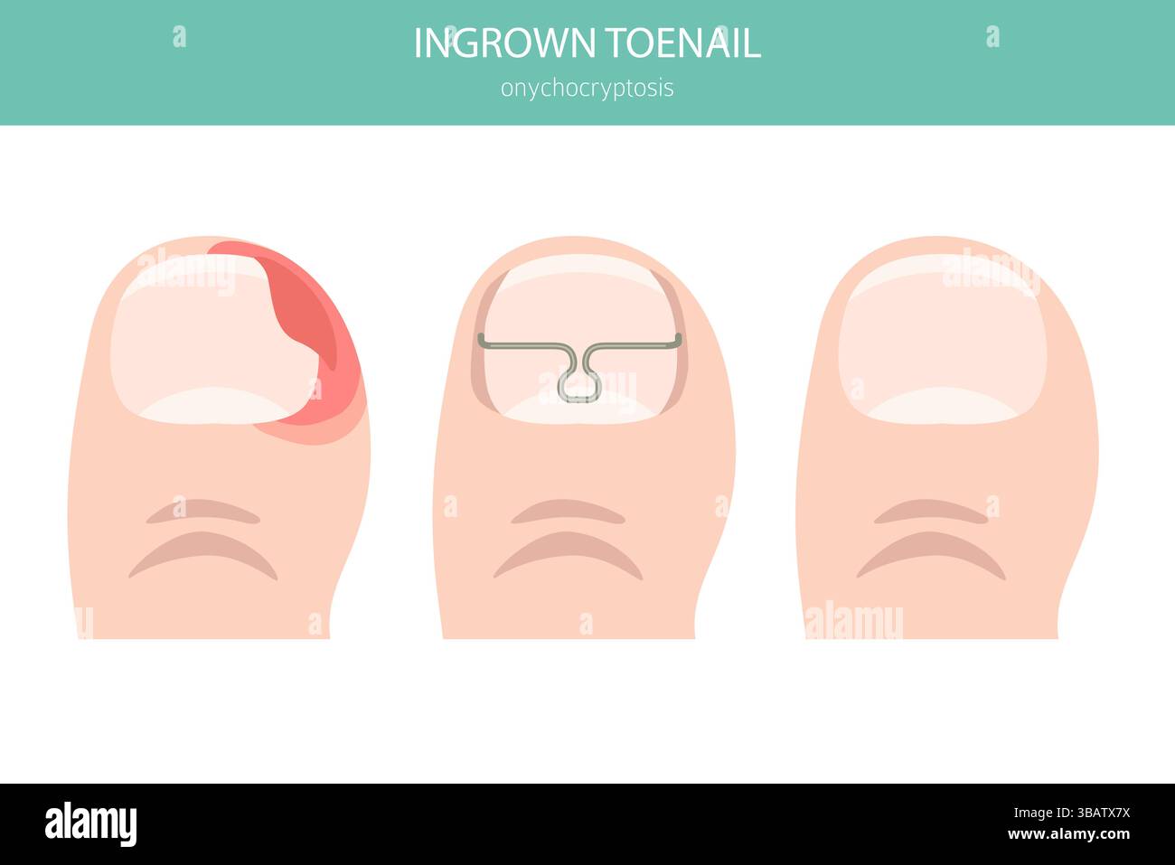 Ingrown toenail, or onychocryptosis, is a nail condition causing pain ...