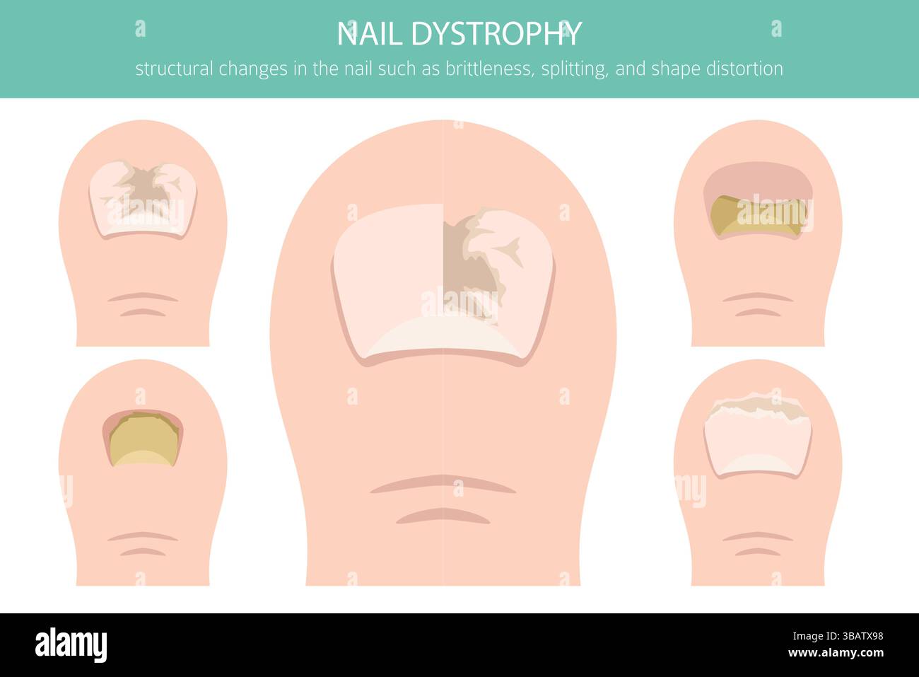 Nail dystrophy. Nail diseases. Medical infographic design. Vector ...