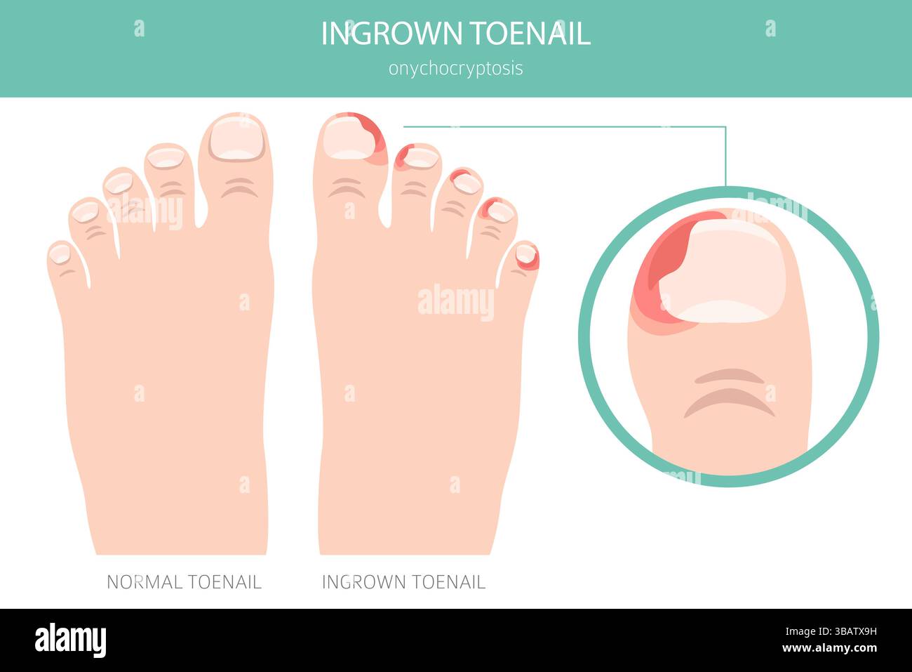 Nail anatomy matrix hi-res stock photography and images - Alamy
