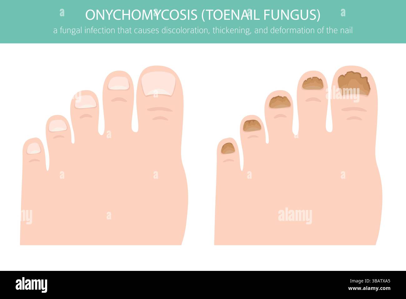 Medical vector illustration of onychomycosis – a common fungal toenail ...
