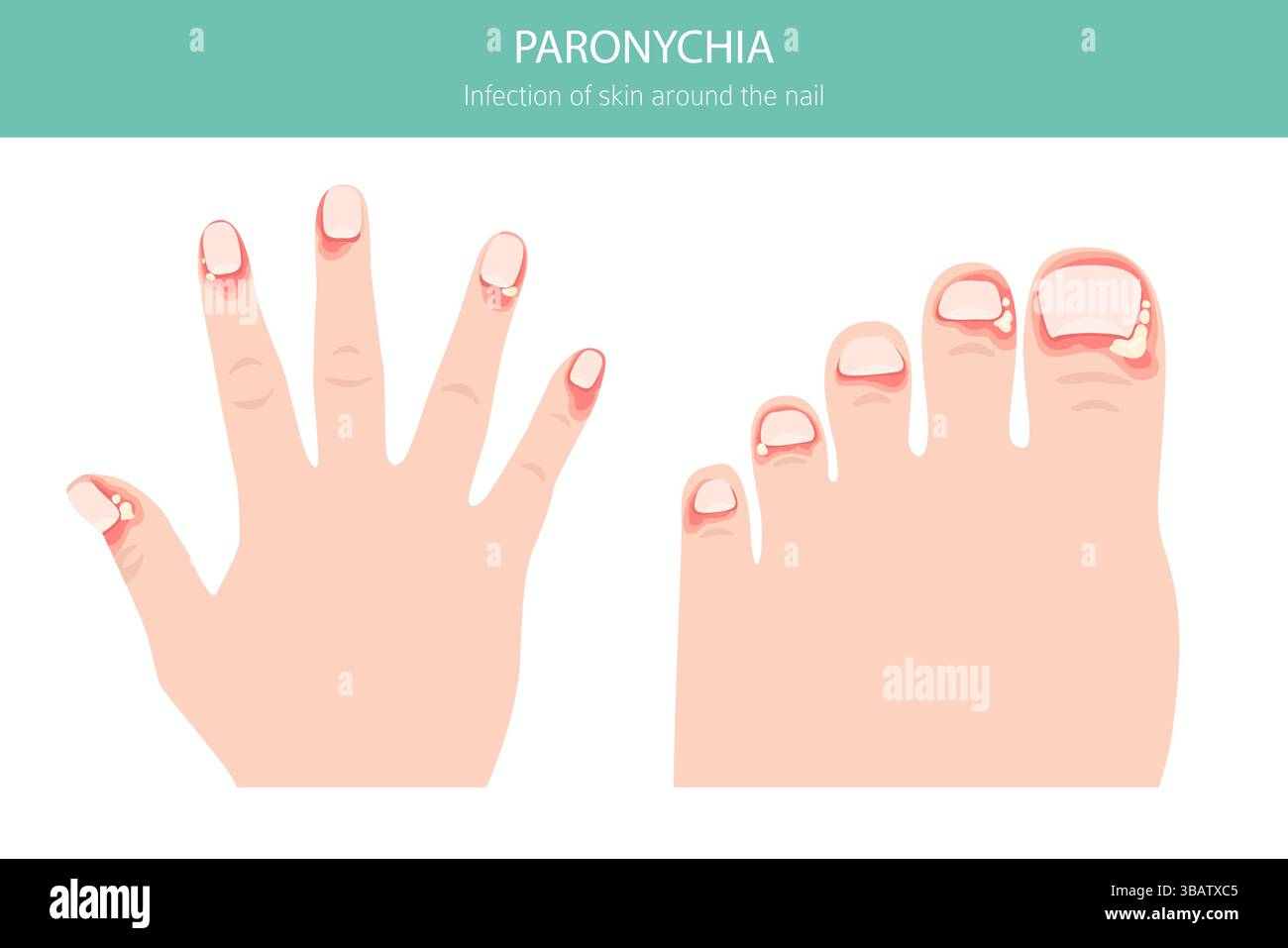 Paronychia is an infection of the nail fold causing redness, swelling ...