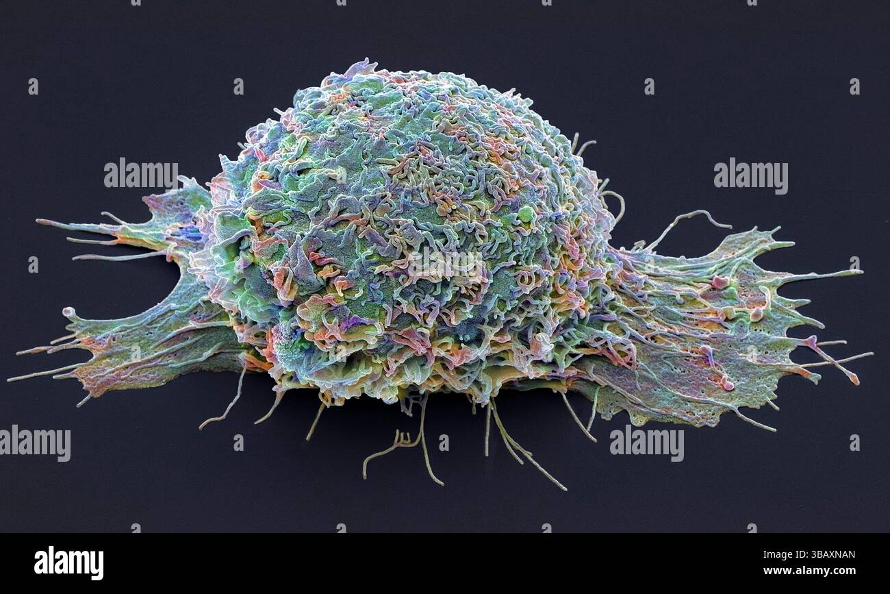 Colorectal cancer cell. Coloured scanning electron micrograph (SEM) of ...