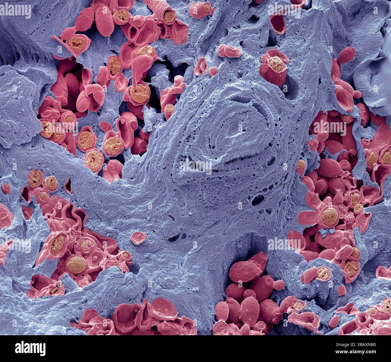 Fungal infection of a tongue. Coloured scanning electron micrograph ...
