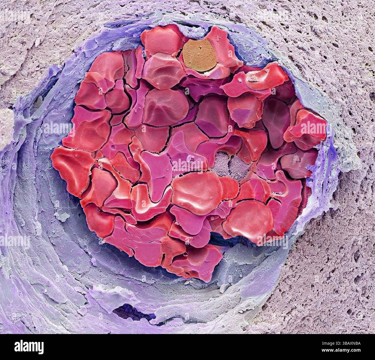 Blood vessel blockage. Coloured scanning electron micrograph (SEM) of a ...