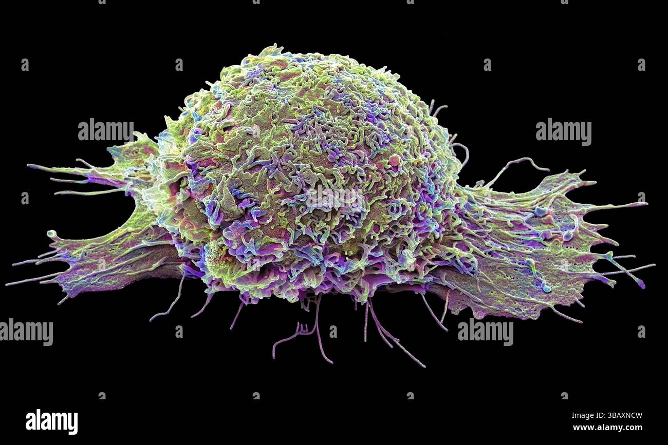 Colorectal cancer cell. Coloured scanning electron micrograph (SEM) of ...