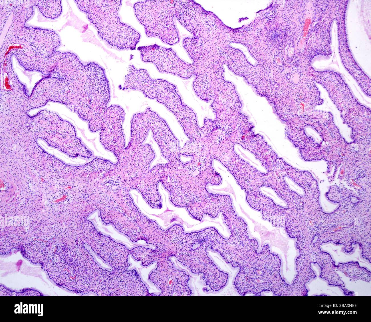 Light micrograph of a human endocervical polyp showing a proliferation ...