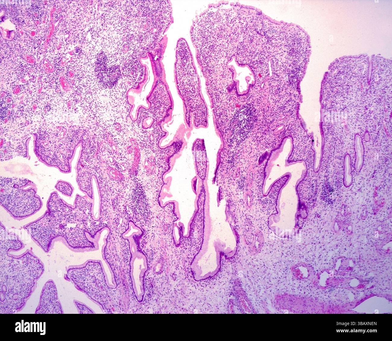 Light micrograph of a human endocervical polyp showing a proliferation ...