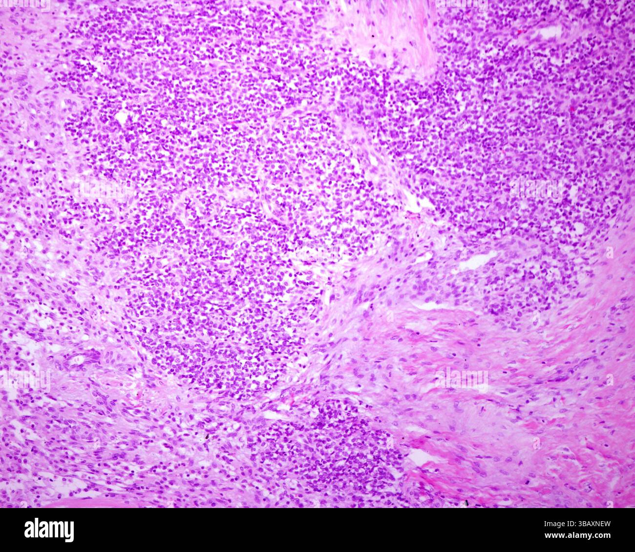 Ewing sarcoma. Light micrograph showing a classic Ewing sarcoma ...
