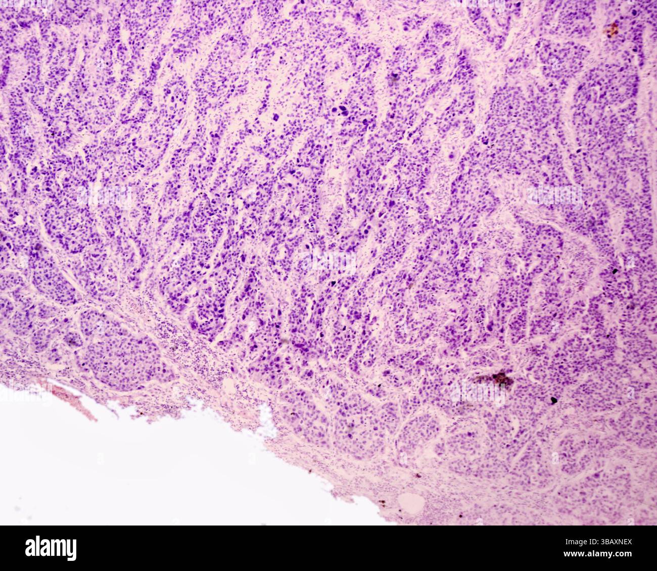 Light micrograph of a squamous cell carcinoma, infiltrative type. This ...