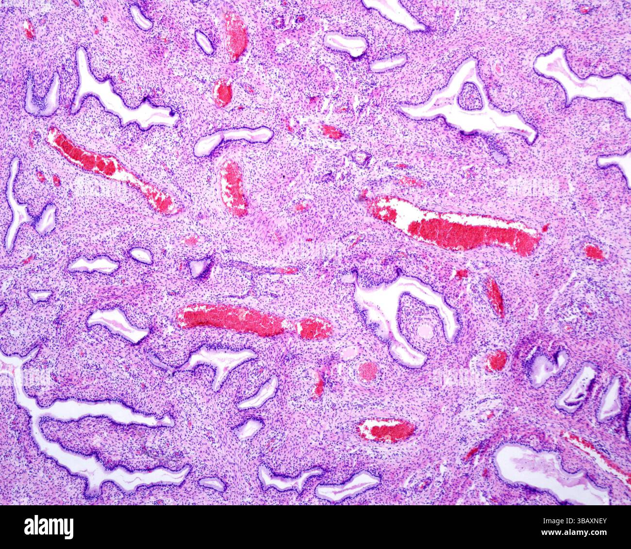 Light micrograph of a human endocervical polyp showing a proliferation ...