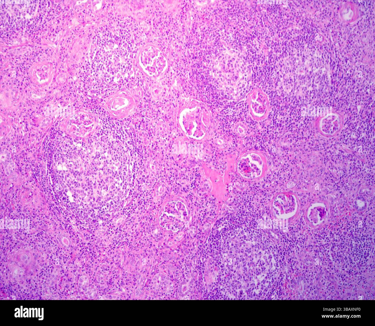 Light micrograph of a human kidney in a case of miliary tuberculosis ...