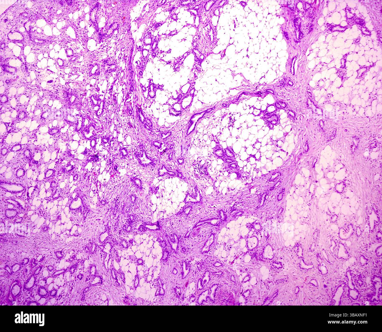 Light micrograph of metastasis of a biliary adenocarcinoma in the ...