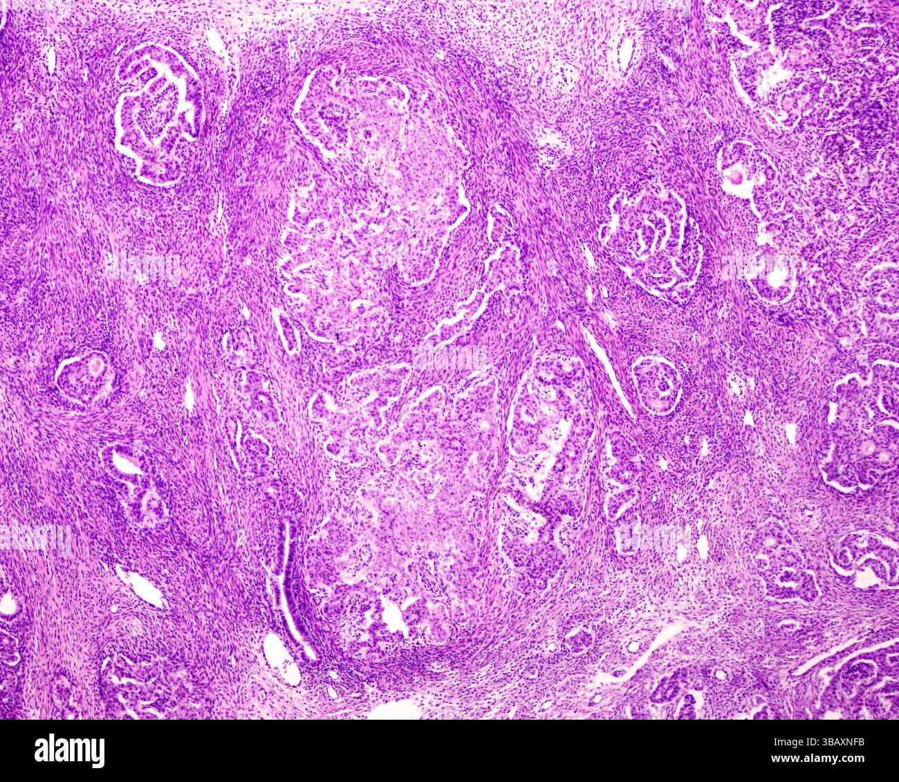 Light micrograph of an adenocarcinoma prostate cancer, the most common ...