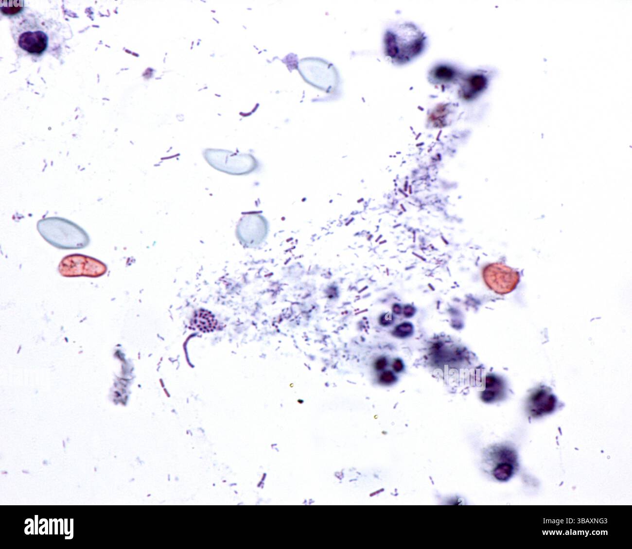 Vaginitis, light micrograph. Vaginal smear showing yeast forms of ...