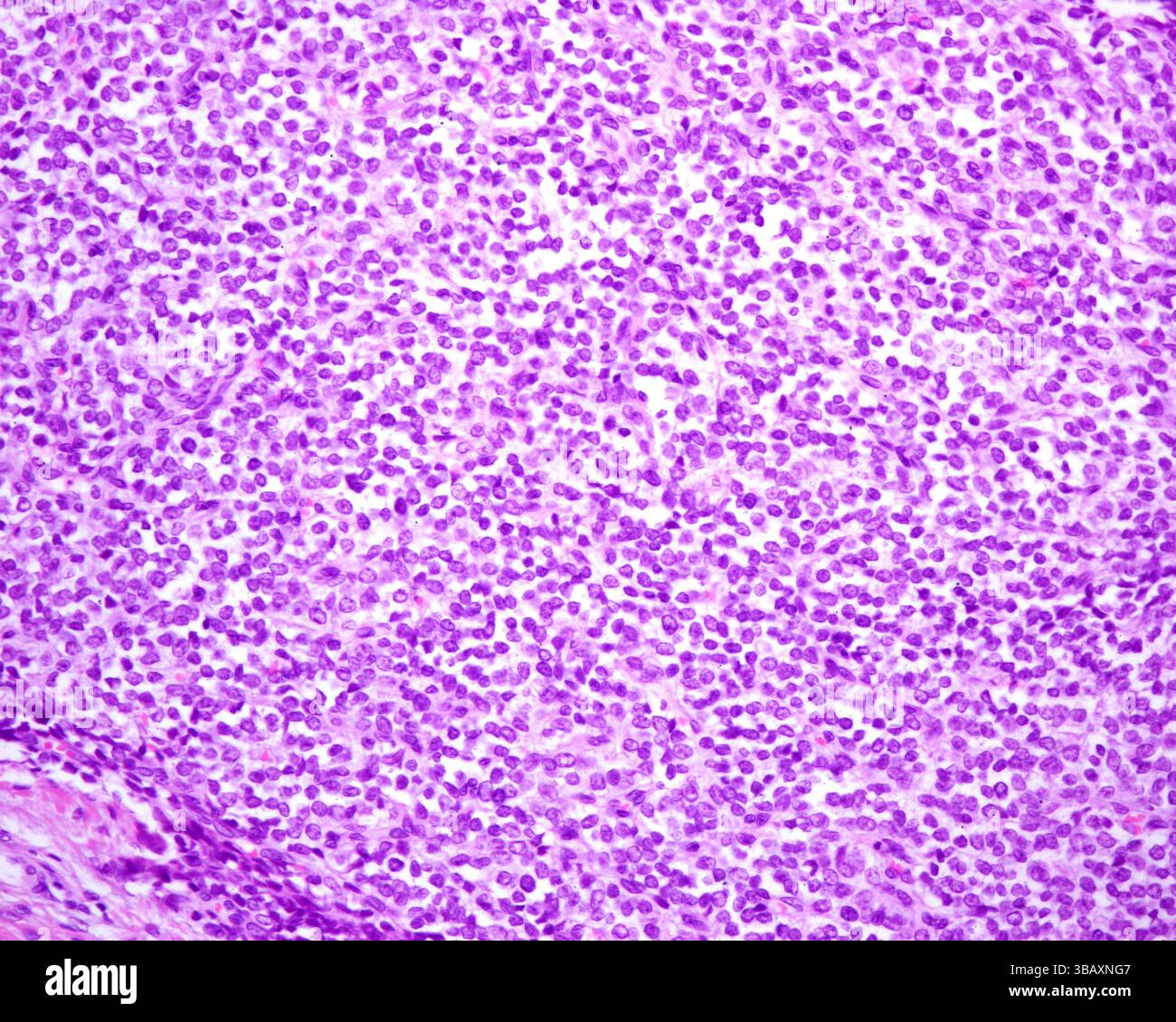 Ewing sarcoma. Light micrograph showing a classic Ewing sarcoma ...