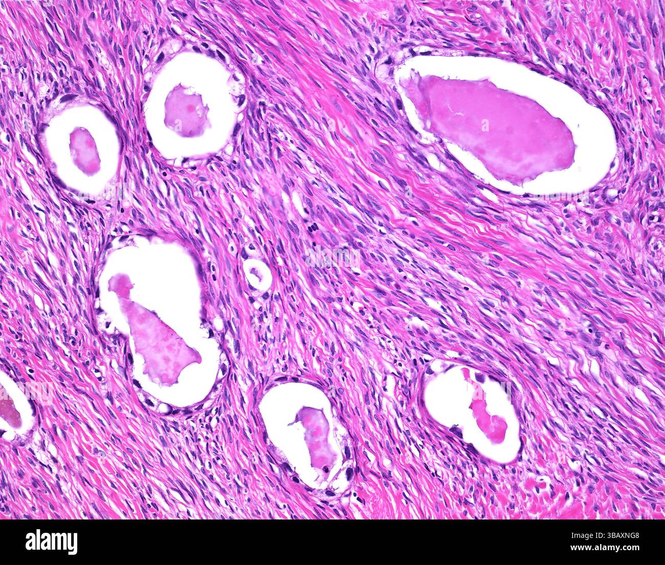 Clear cell adenofibroma of an ovary, light micrograph. Clear cell ...