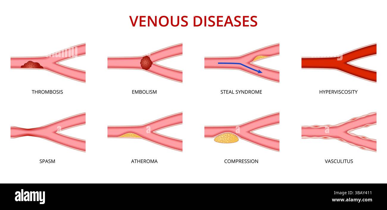 Human vein disease, venous disorders vector set. Thrombosis, embolism ...