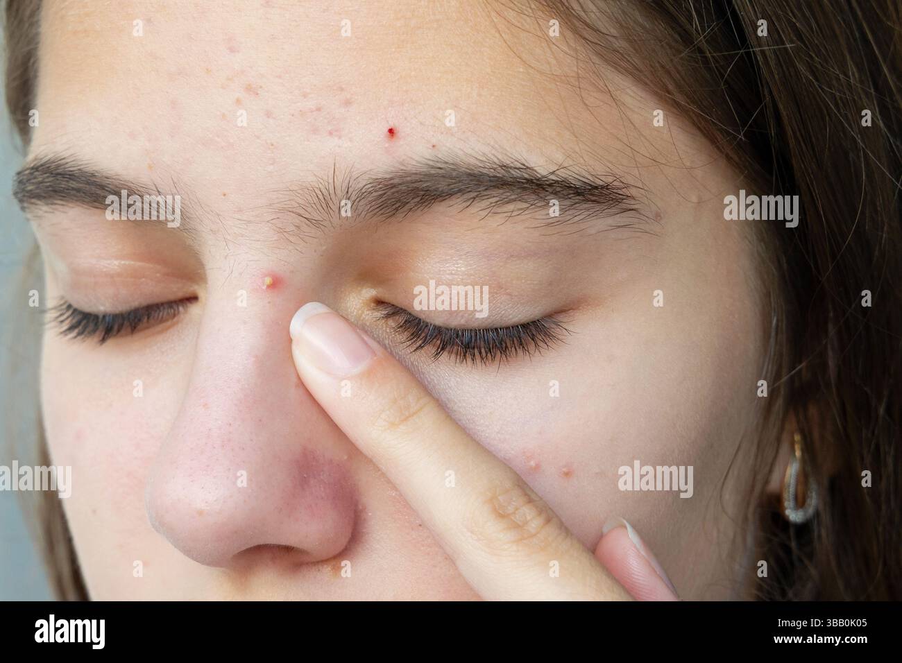 Close-up of acne on teenage skin. Close-up image of a young woman ...