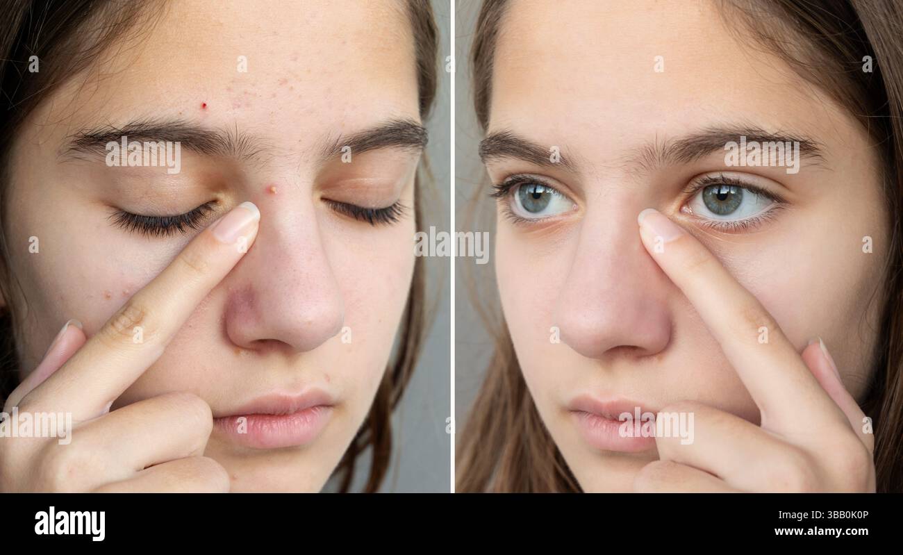 Teen girl touching acne on her forehead and nose. A close-up of a ...