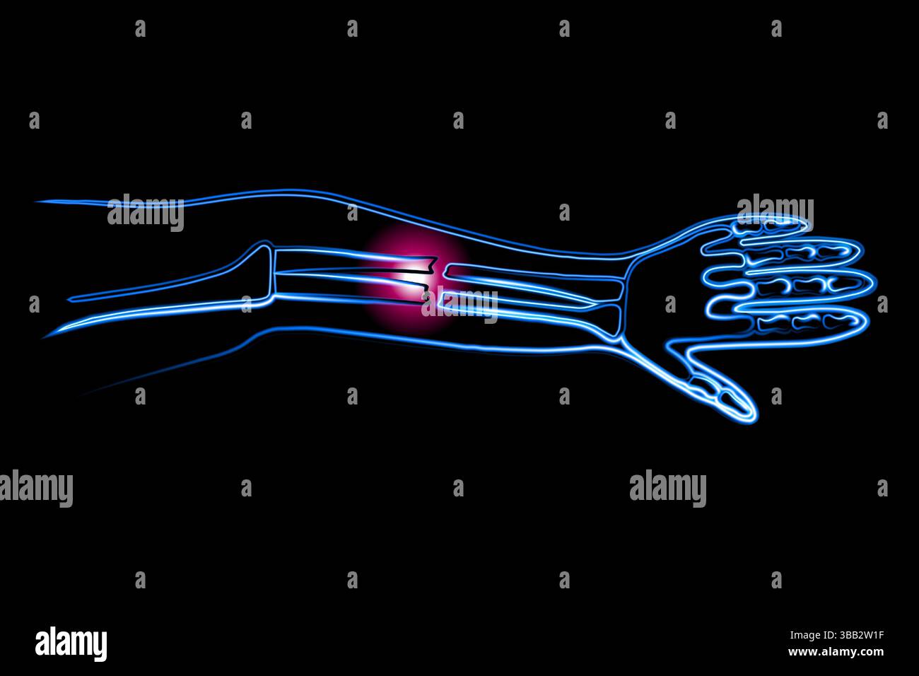 Vector isolated illustration of a closed forearm fracture. Outline ...