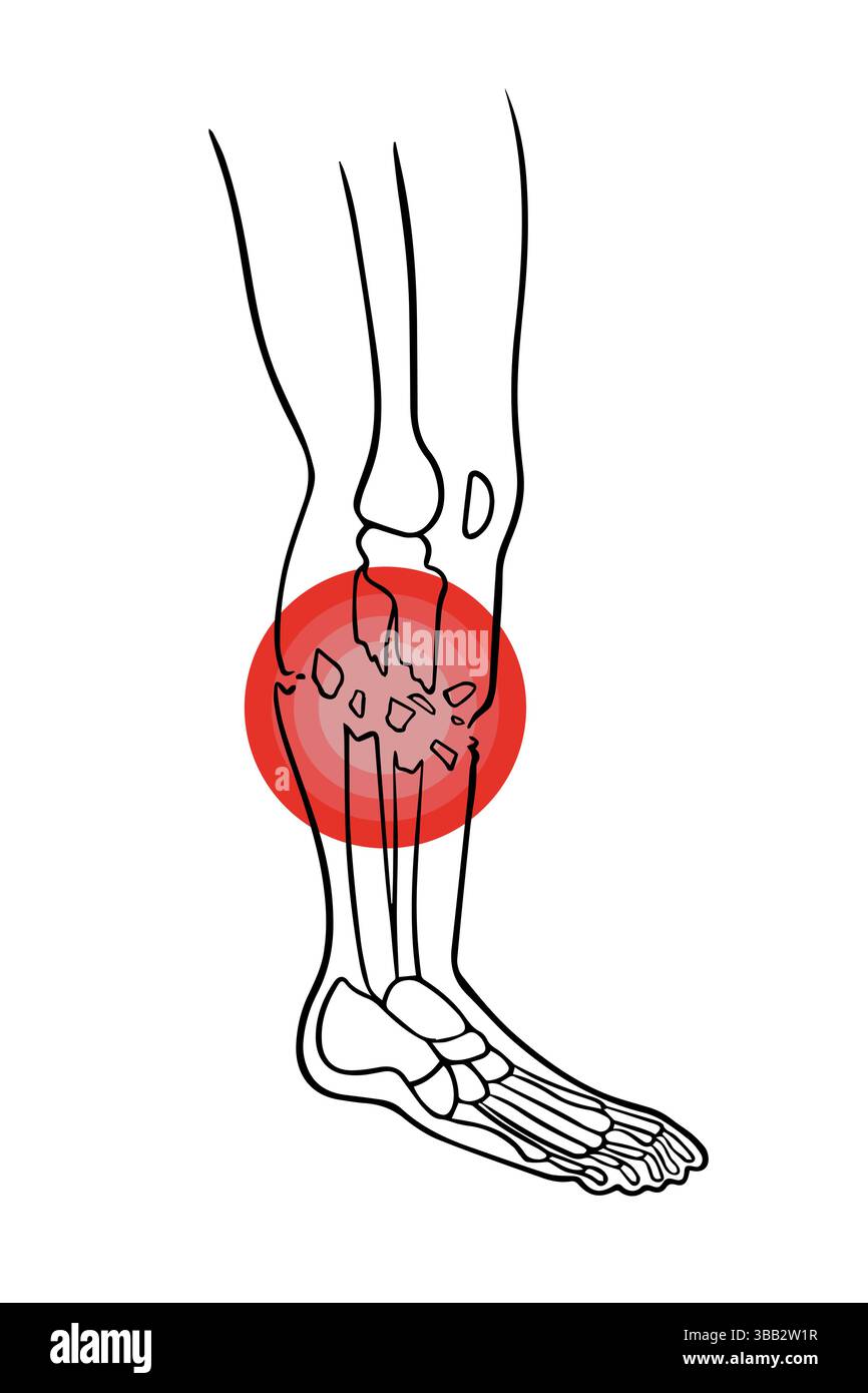Vector isolated illustration of an open fracture of the tibia. X-ray of ...