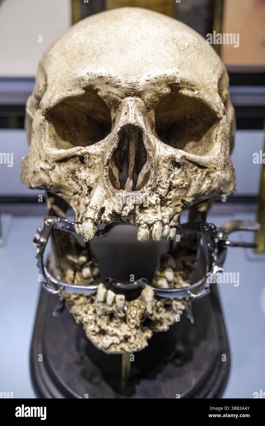 Human skull with dental prosthesis medical studies, and health Stock ...