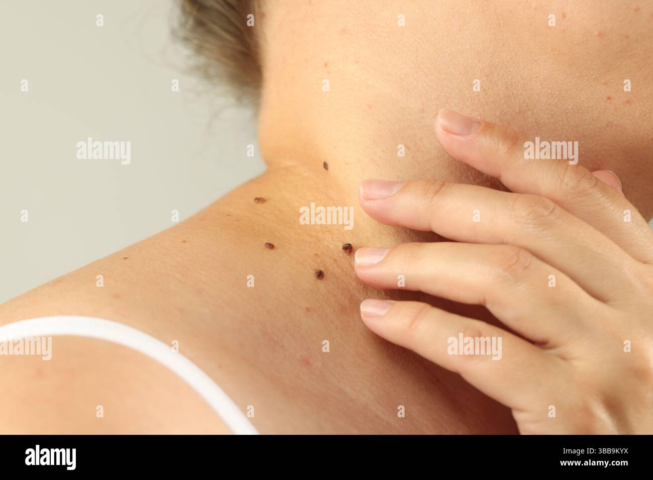 Woman with moles on her skin against grey background, closeup Stock ...