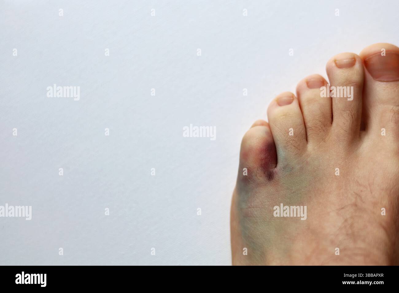 Male foot with a broken bone and bruising on the simple, white ...
