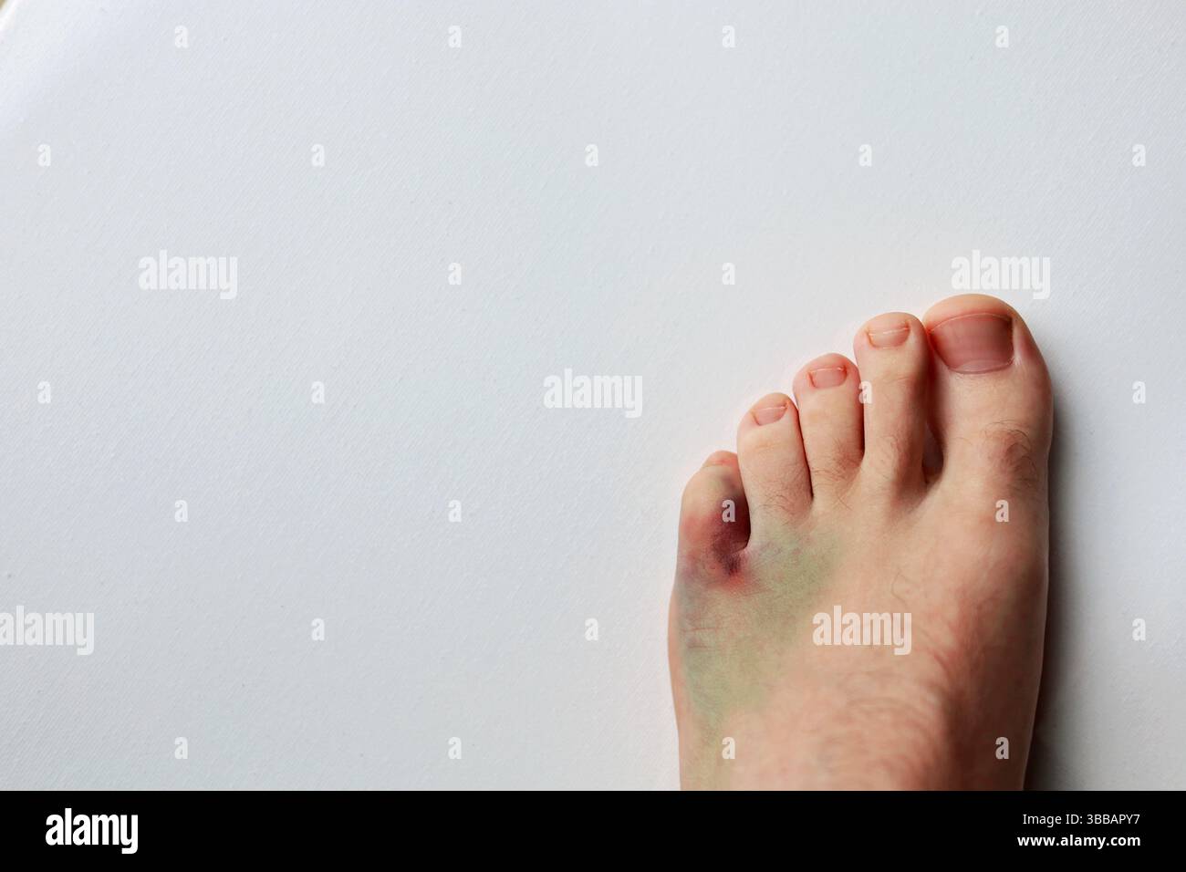 Male foot with a broken bone and bruising on the simple, white ...
