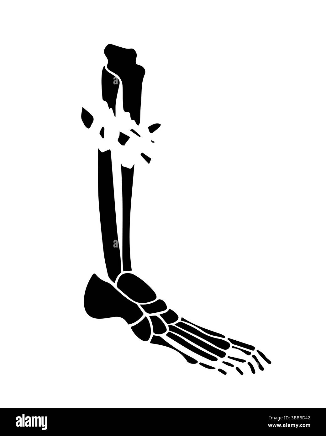 Vector isolated illustration of an open fracture of the tibia. X-ray of ...