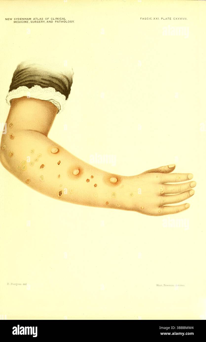 The Hand From A Case Of Hebra’s Sarcoma Melanodes. Vintage Archive ...