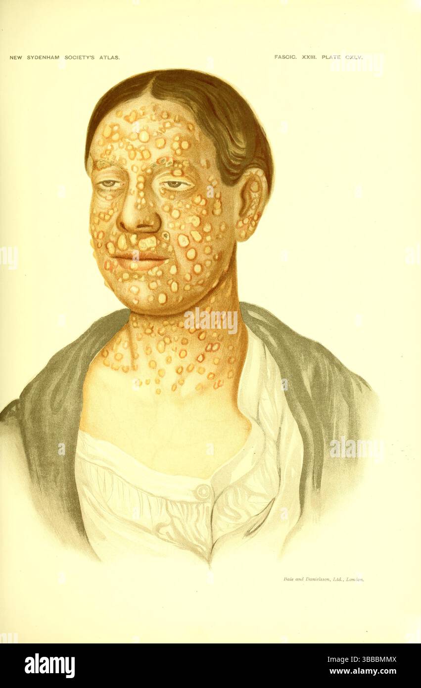 The Vesiculo-bullous Form Of The Iodide Eruption. Vintage Archive ...