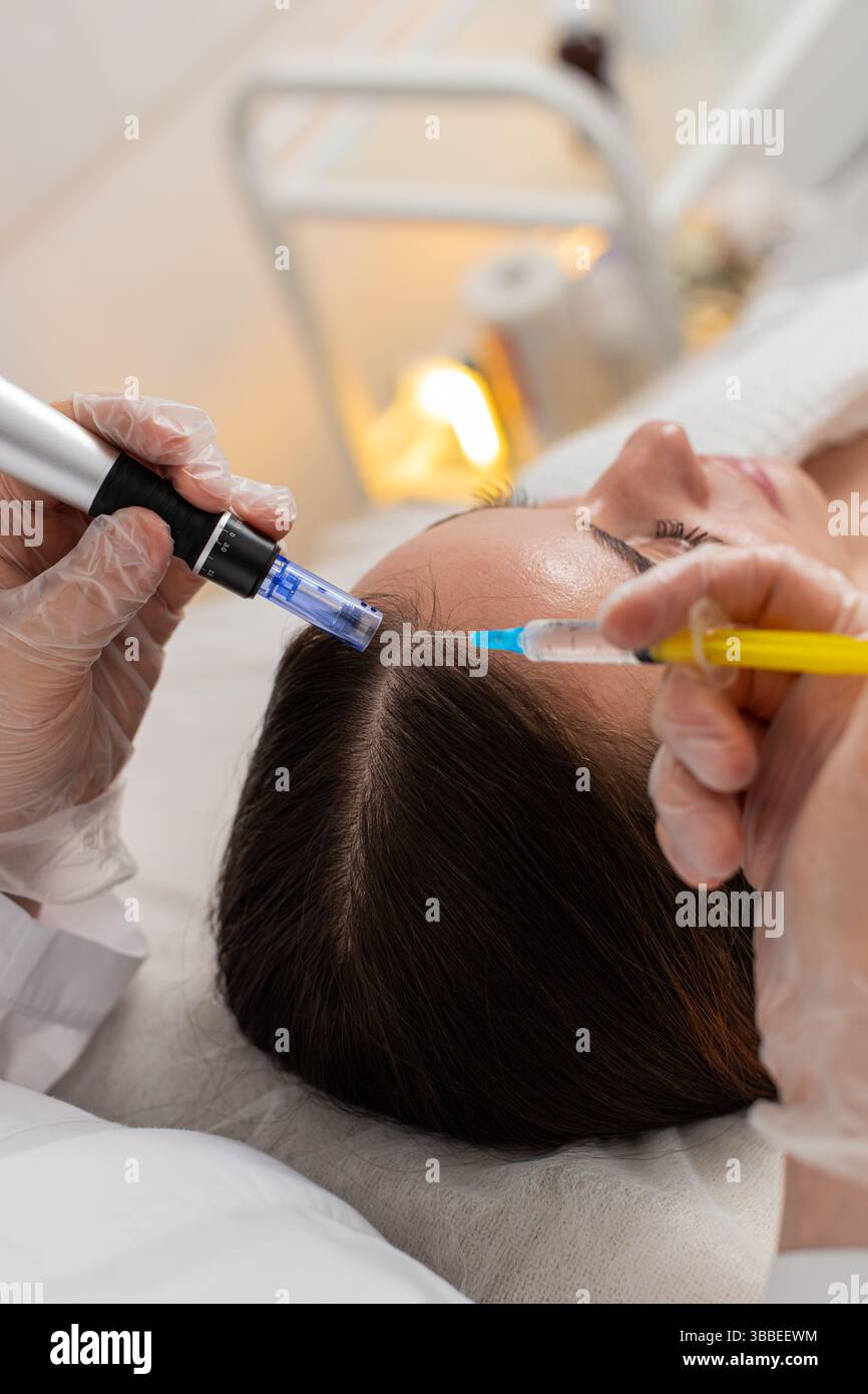 Alopecia. Caucasian girl receives targeted scalp therapy with dermapen ...