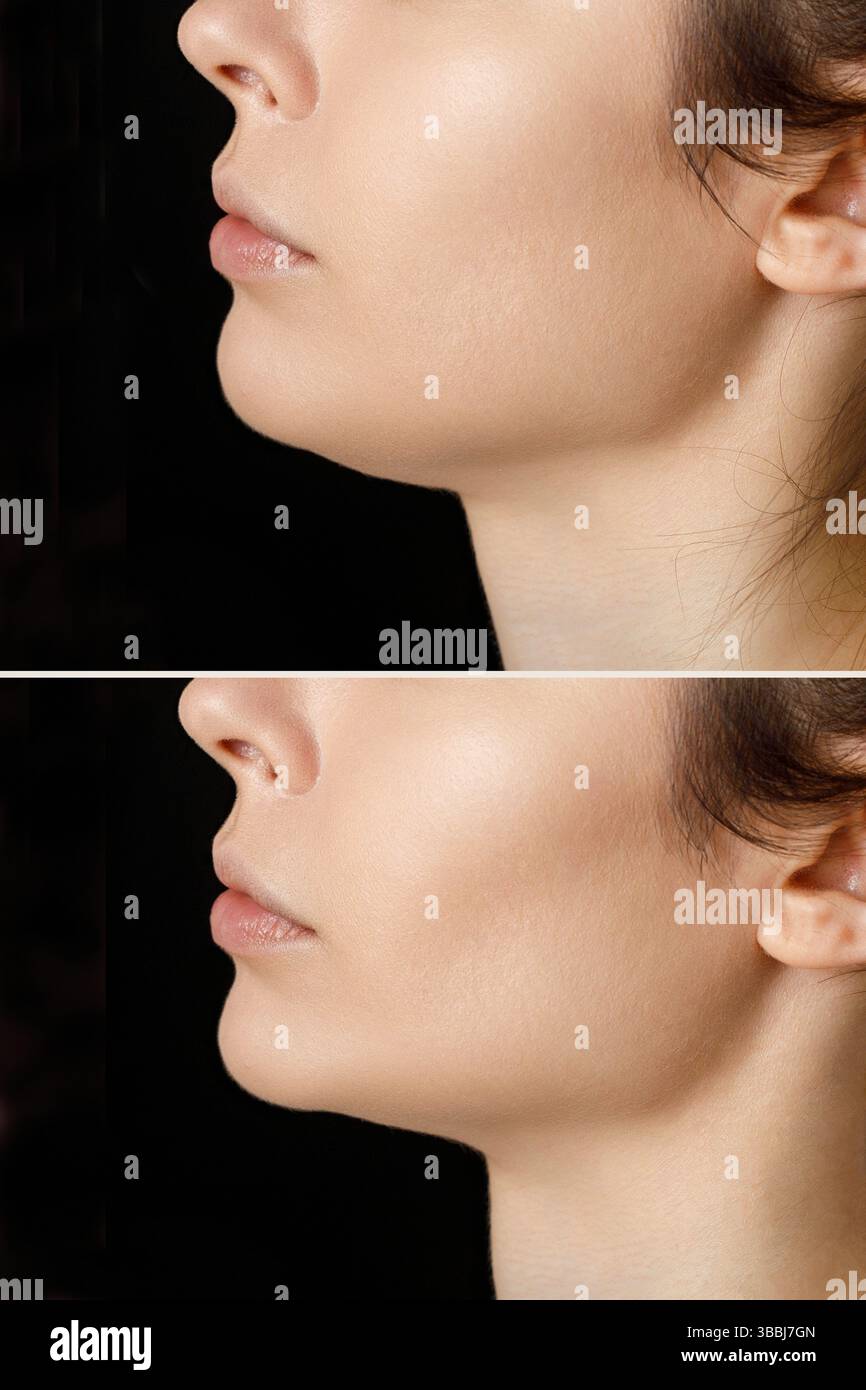 Female double chin before and after correction. Correction of the chin ...