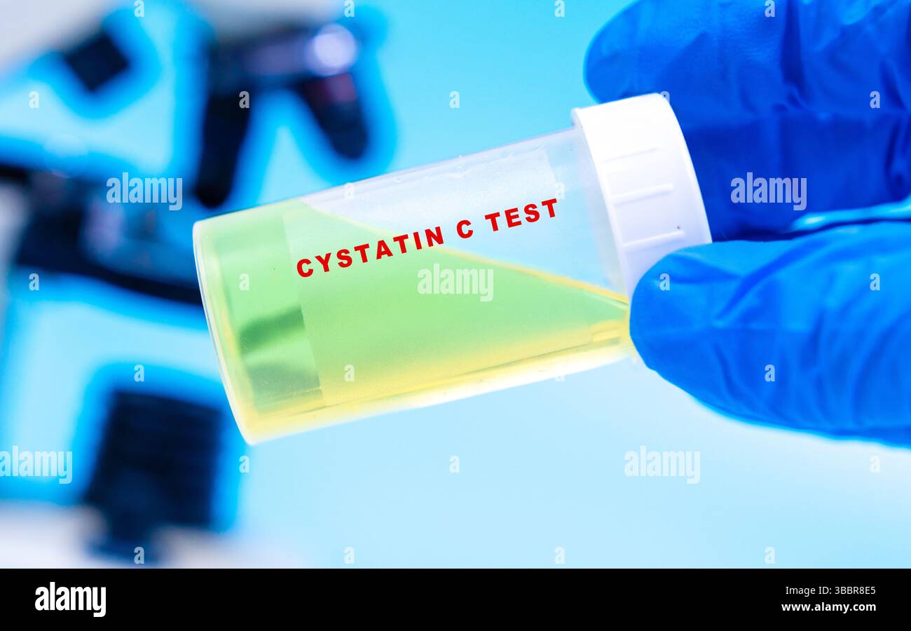Cystatin C urine test. Evaluates kidney function by measuring cystatin ...