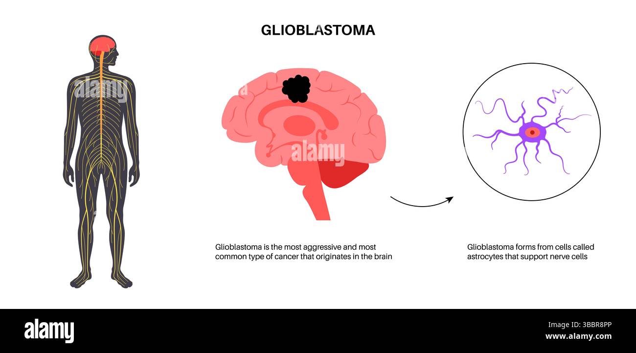 Illustration of a glioblastoma. This is a highly aggressive, cancerous ...