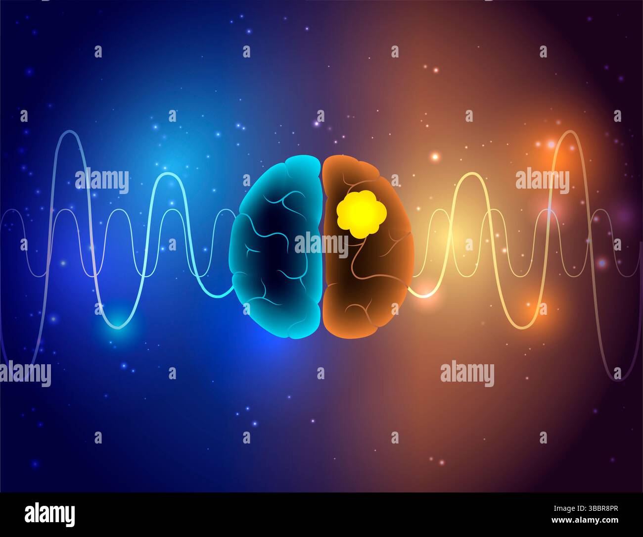 Illustration of brain cancer. A cancerous growth that develops in the ...