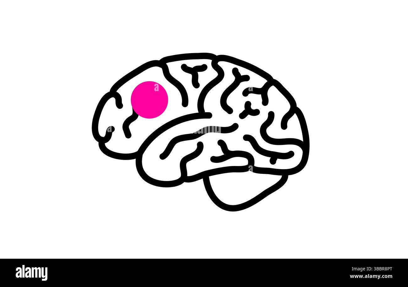 Illustration of brain cancer. A cancerous growth that develops in the ...