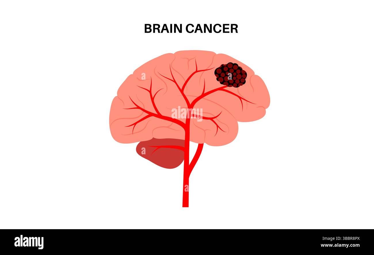 Illustration of brain cancer. A cancerous growth that develops in the ...