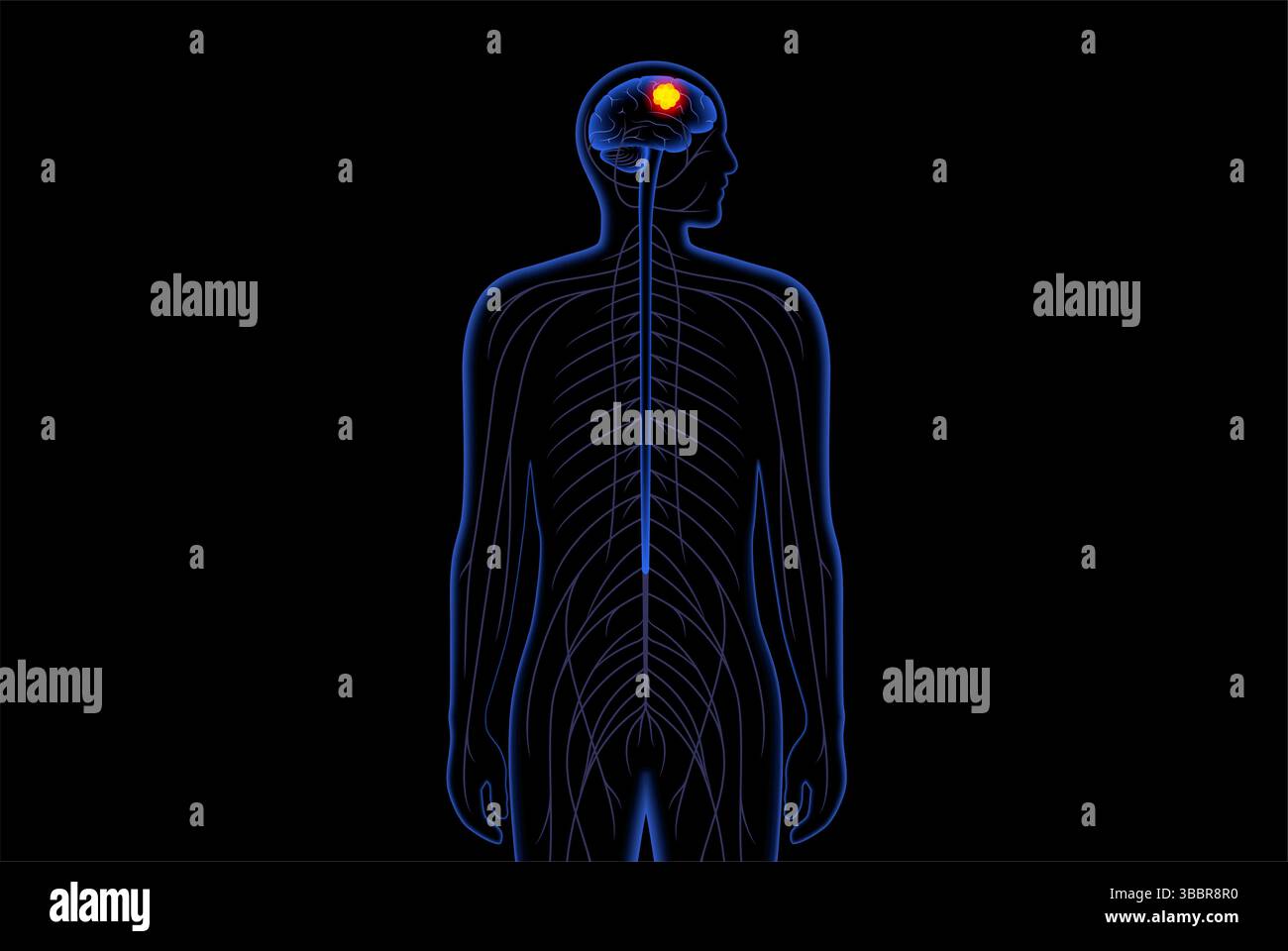 Illustration of brain cancer. A cancerous growth that develops in the ...