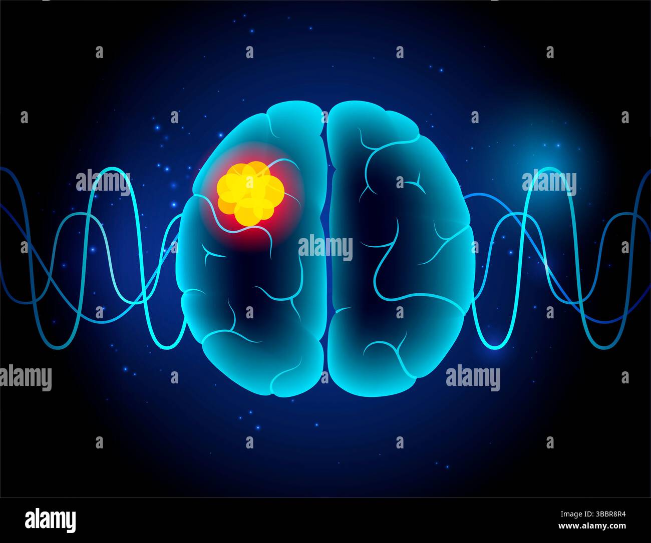 Illustration of brain cancer. A cancerous growth that develops in the ...